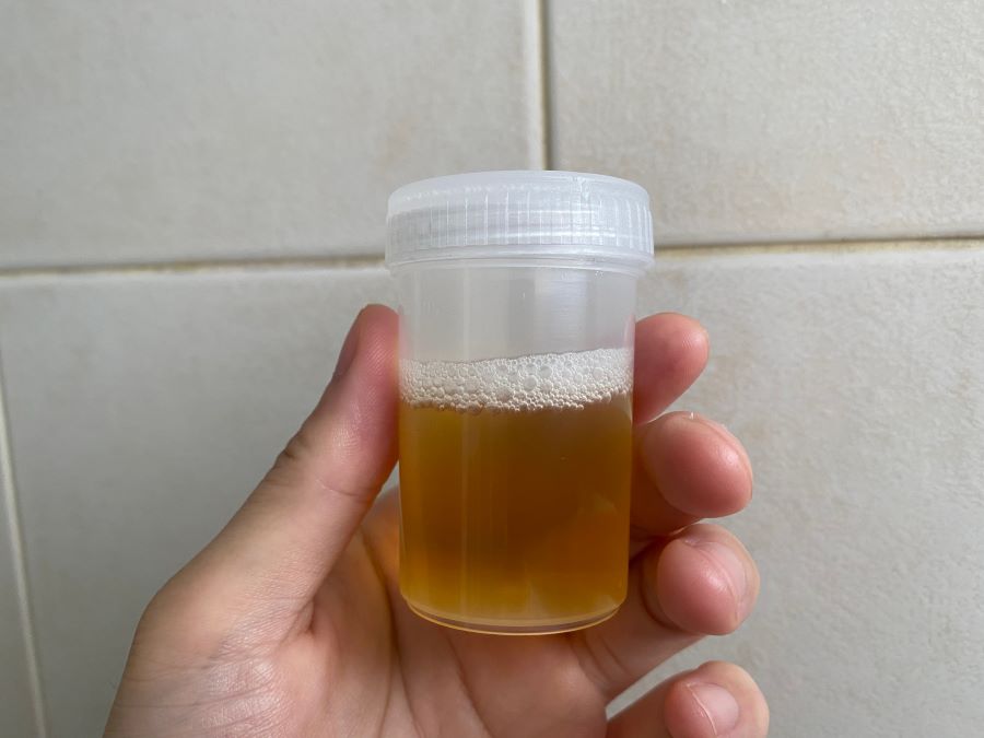 ¿Qué es la proteinuria y cuál es su impacto en la salud renal?